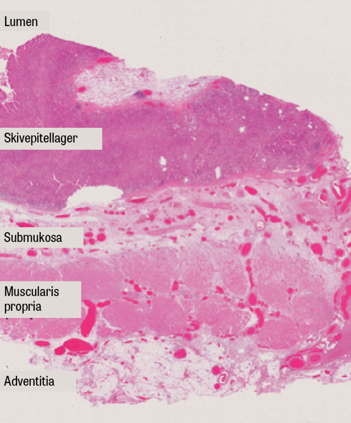 Akut nekrotiserande esofagit – sällsynt men livshotande tillstånd ...