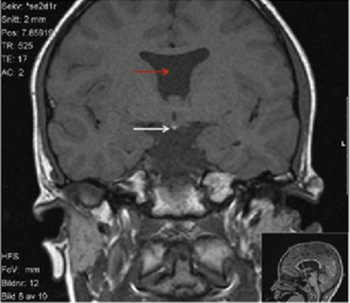 Viktigt att överväga utredning av barn med optikusmissbildningar ...