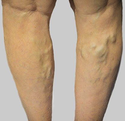 Behandling av varicer i Sverige – underrapporteringen är stor ...