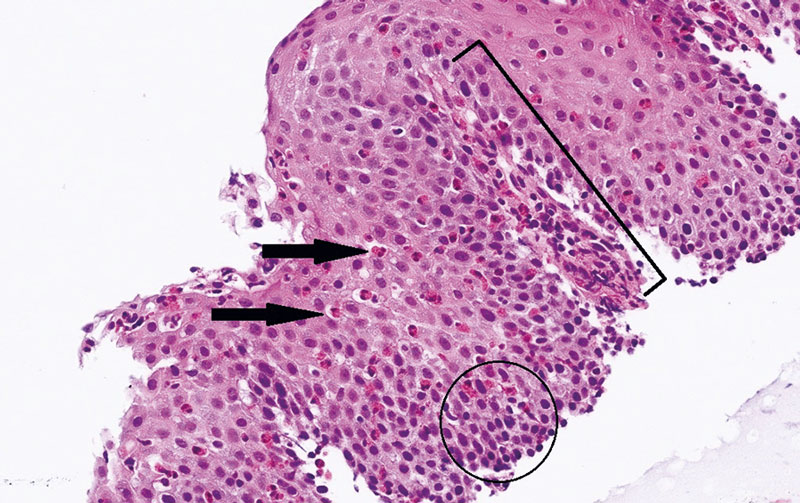 Eosinofil gastrointestinal sjukdom – tillstånd med skiftande symtom ...