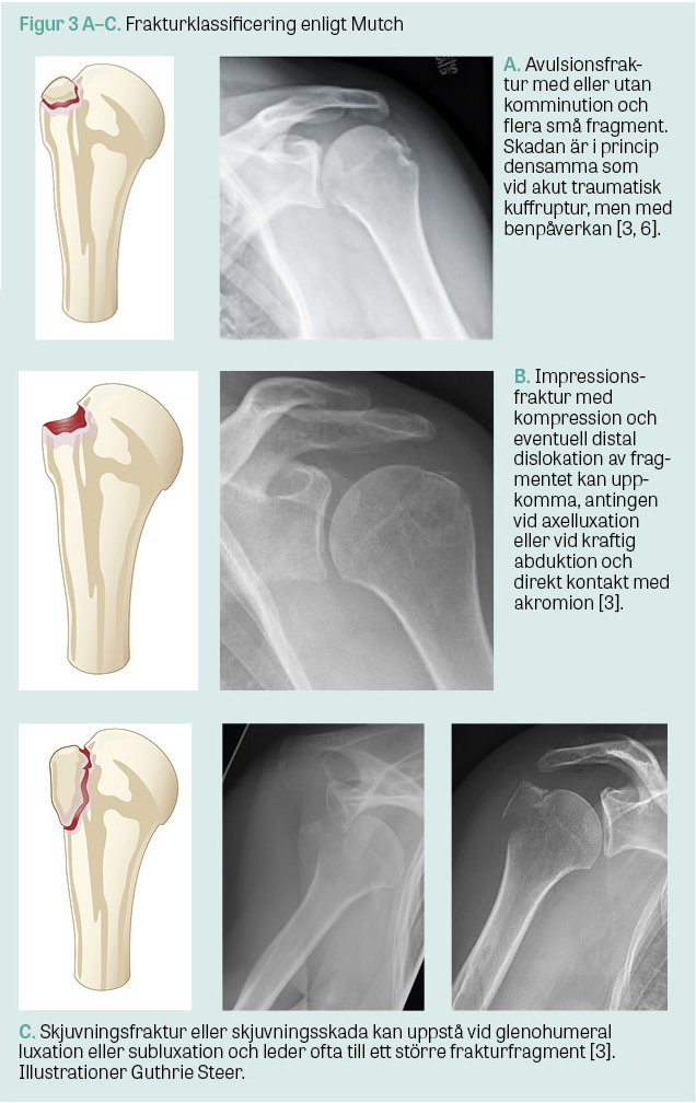 Tuberculum majus-fraktur – inte alltid en benign skada – Läkartidningen
