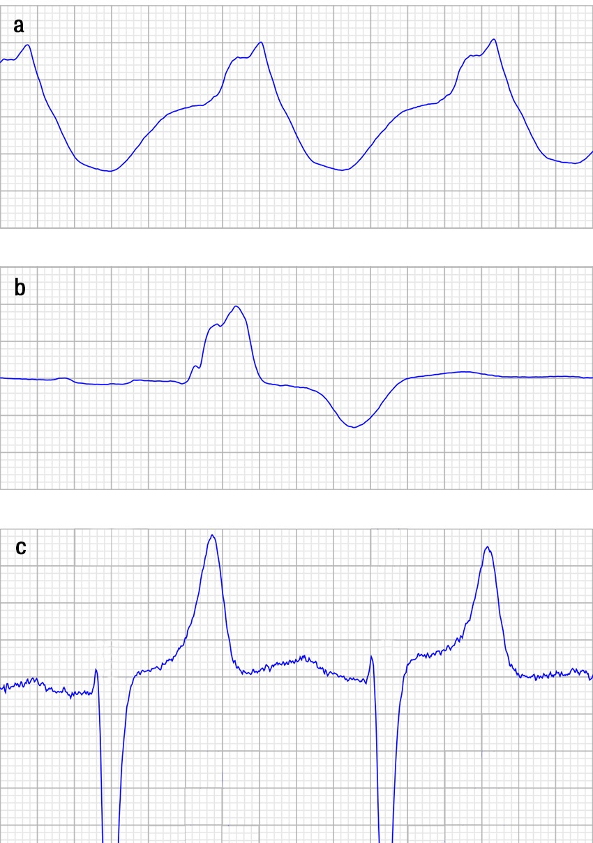 ABC om Hyperkalemi – Läkartidningen