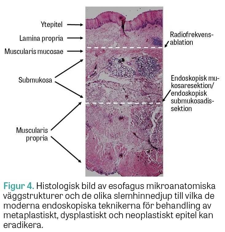 Diagnos, behandling, risk och kontroll vid Barretts esofagus ...