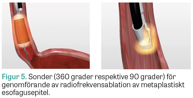 Diagnos, behandling, risk och kontroll vid Barretts esofagus ...