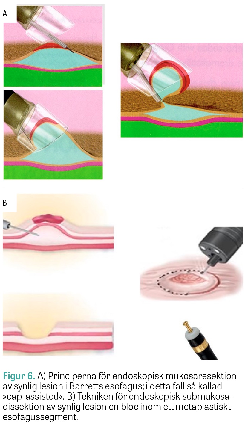 Diagnos, behandling, risk och kontroll vid Barretts esofagus ...