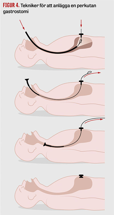 Perkutan endoskopisk gastrostomi – nya nationella rekommendationer ...