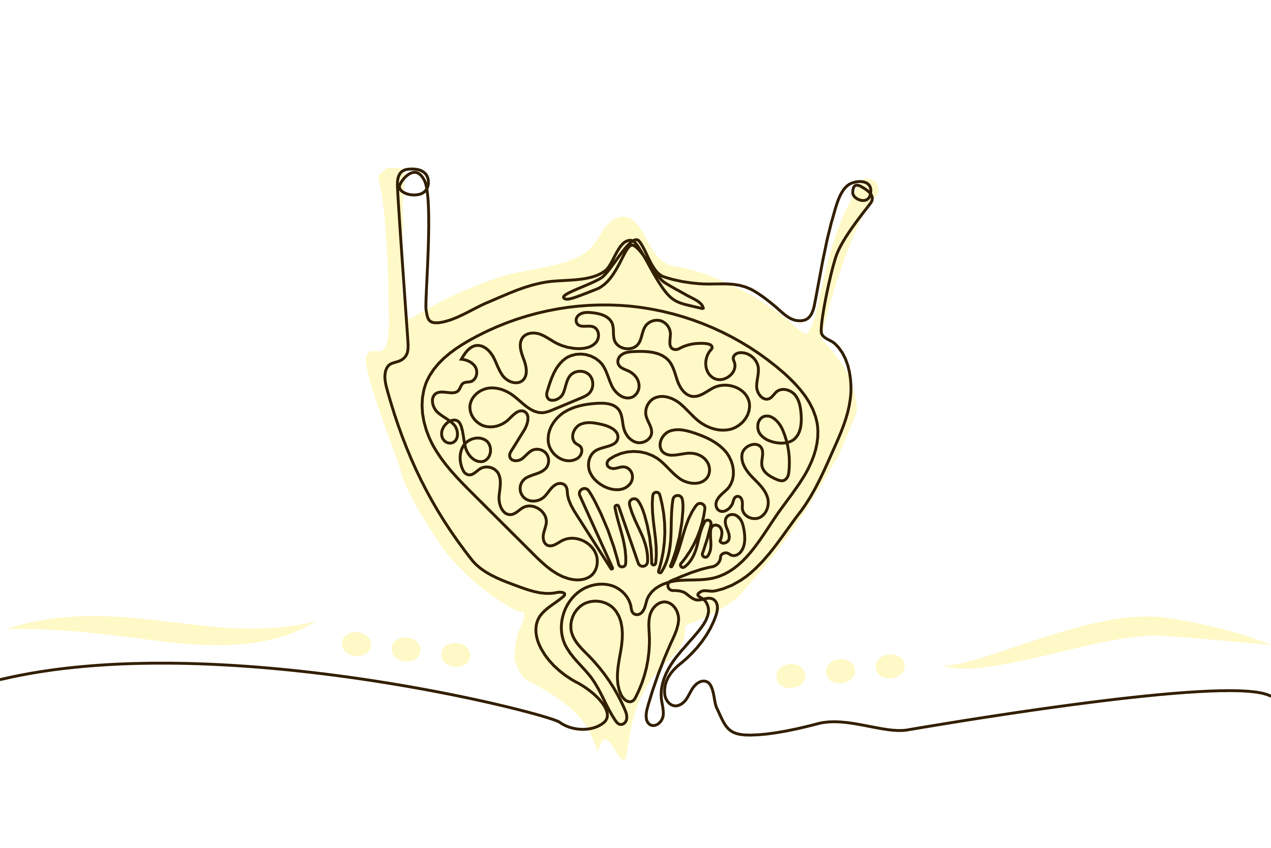 SVF för cancer i urinblåsan och övre urinvägarna bör revideras ...