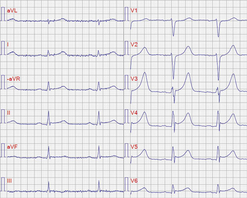 Perikardit och myokardit – Läkartidningen