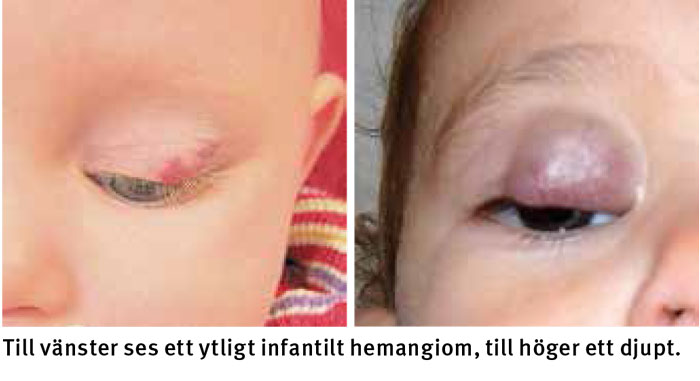 Vaskulära lesioner, del 1: – Läkartidningen