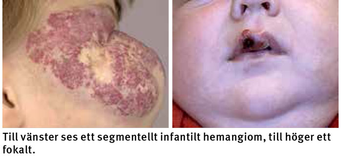 Vaskulära lesioner, del 1: – Läkartidningen