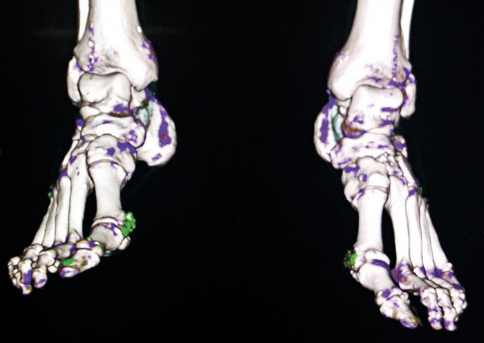 Ny diagnostik och behandling vid gikt – Läkartidningen