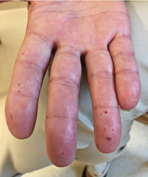 Systemisk skleros – en ovanlig men viktig diagnos i primärvården ...