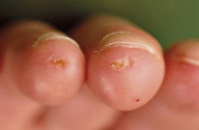 Systemisk skleros – en ovanlig men viktig diagnos i primärvården ...