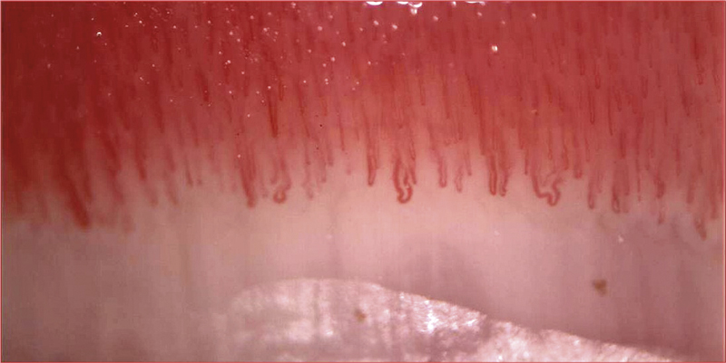 Systemisk skleros – en ovanlig men viktig diagnos i primärvården ...