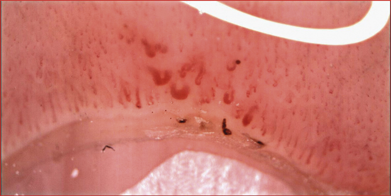 Systemisk skleros – en ovanlig men viktig diagnos i primärvården ...