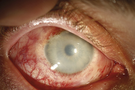 Kemiska ögonfrätskador – akut diagnostik och behandling – Läkartidningen