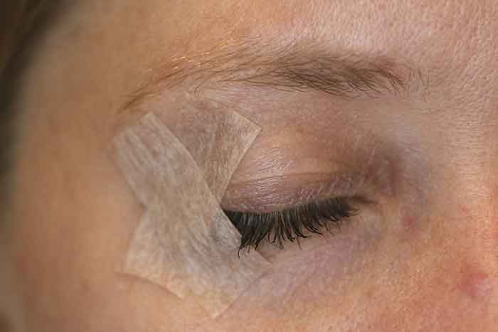 Bells pares ger resttillstånd hos 30 procent av vuxna patienter ...