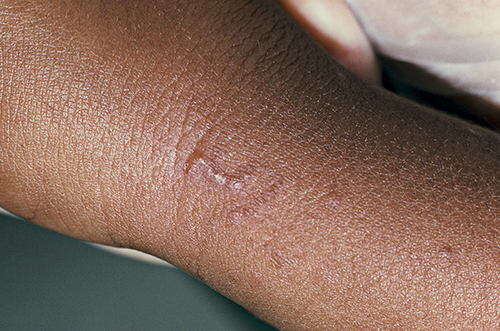 Vid klåda, tänk alltid på skabb! – Läkartidningen