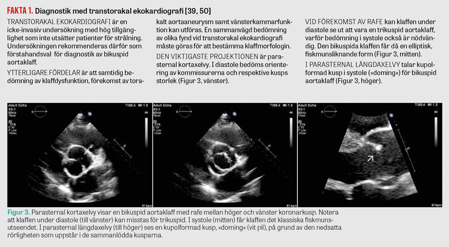 Bikuspid aortaklaff – vanligaste medfödda hjärtmissbildningen ...