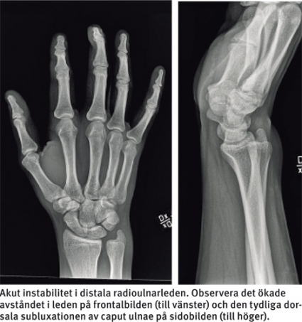 Handledens ligamentskador – diagnostik – Läkartidningen