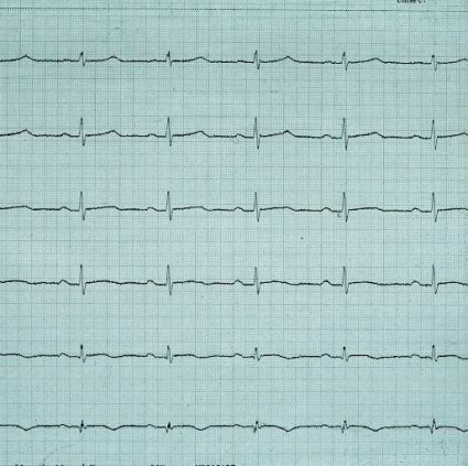 ABC om Akut lungemboli – Läkartidningen