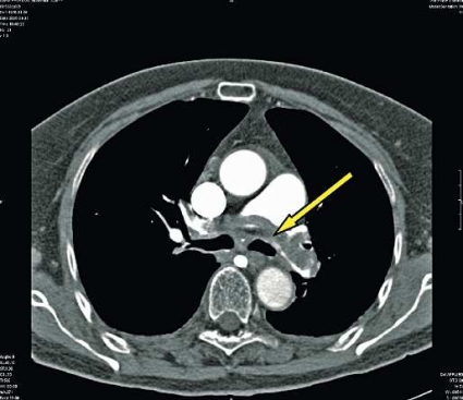 ABC om Akut lungemboli – Läkartidningen