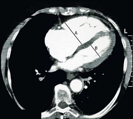ABC om Akut lungemboli – Läkartidningen