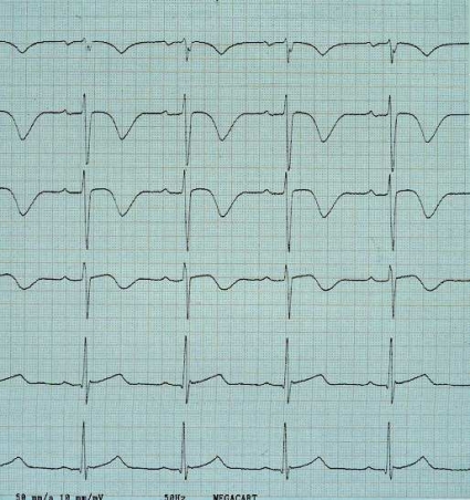 ABC om Akut lungemboli – Läkartidningen