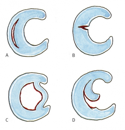 Menisk- och korsbandsskador – Läkartidningen